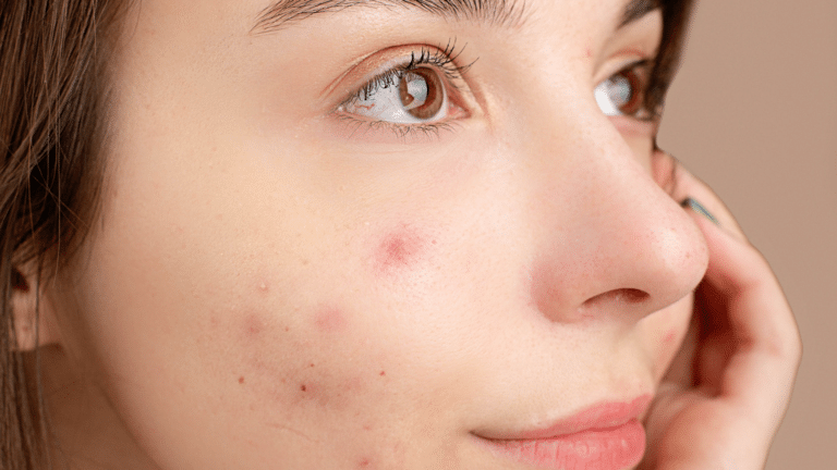 The Ultimate Guide to Acne Prone Skin, Meaning, Causes, and Care Tips ...